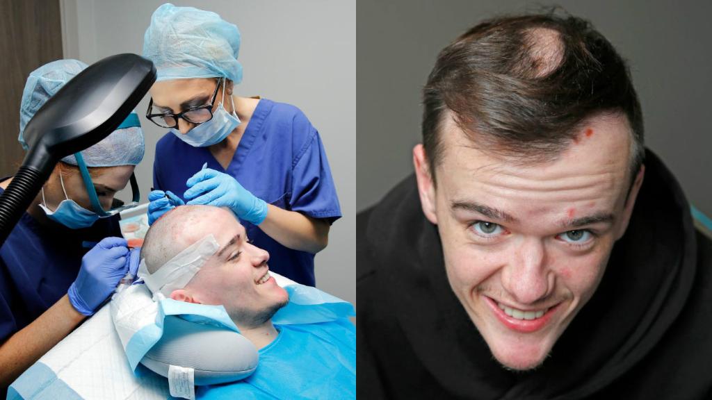 BGT winner George Sampson has a £9,000 hair transplant after his act ...