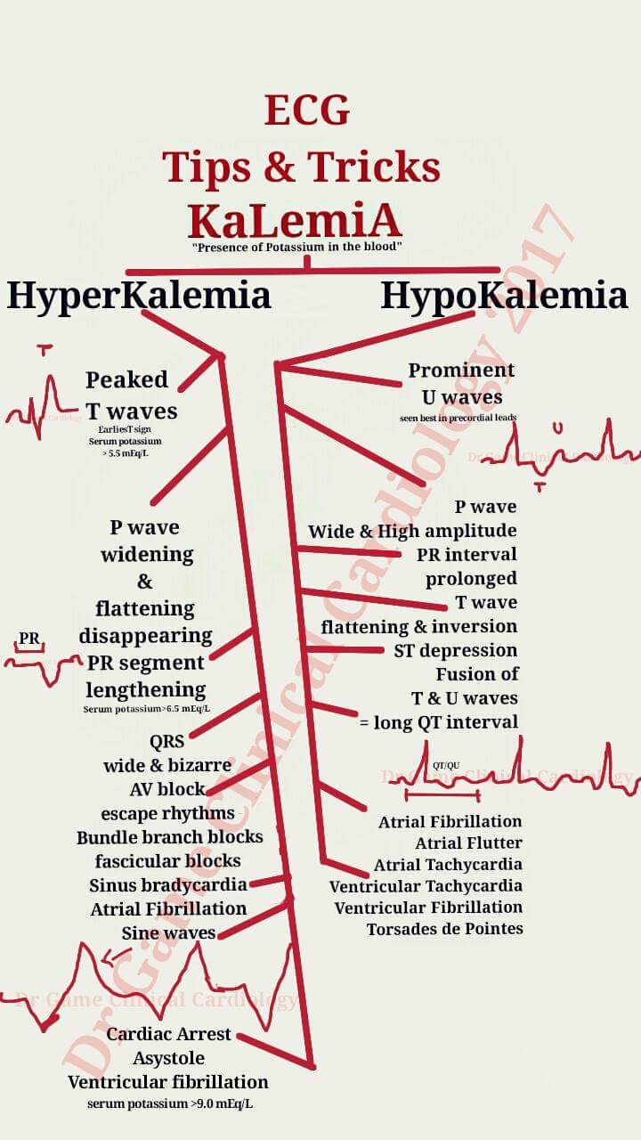 Hypokalemia Hyperkalemia Ecg