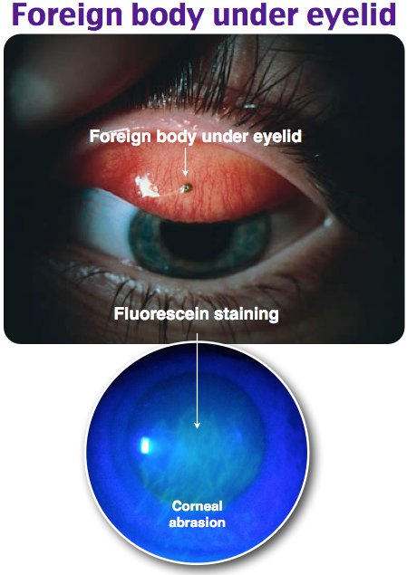 Corneal Foreign Body Fluorescein
