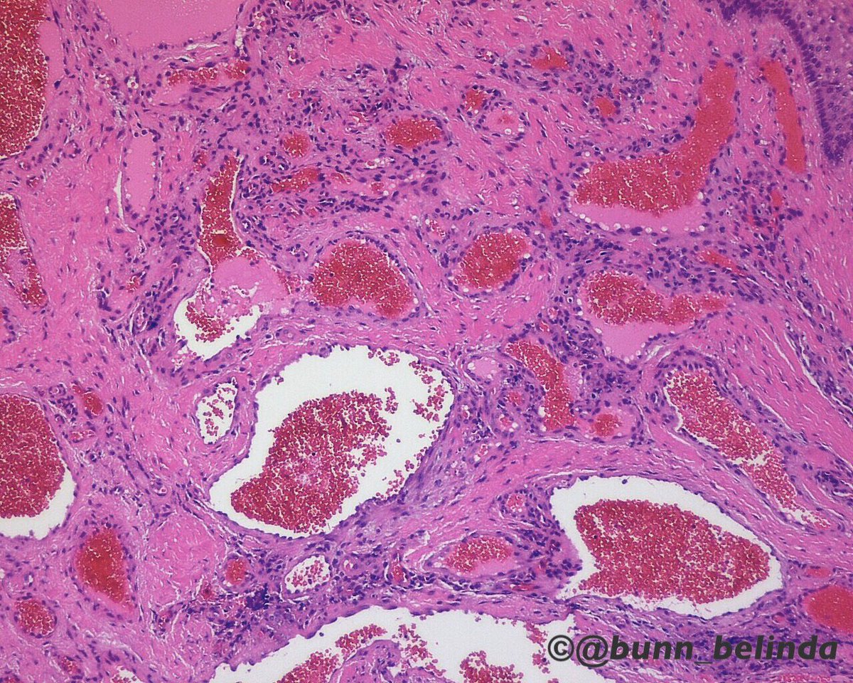 Arteriovenous Malformation Histology