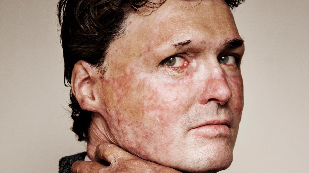 Het meest gelezen artikel vandaag. Leven met brandwonden: 'Humor is ...