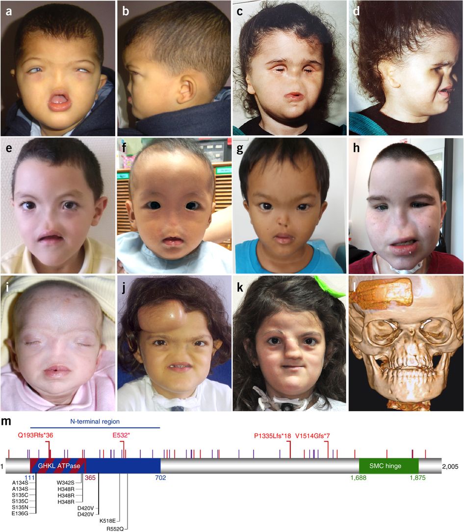 What Causes Microphthalmia