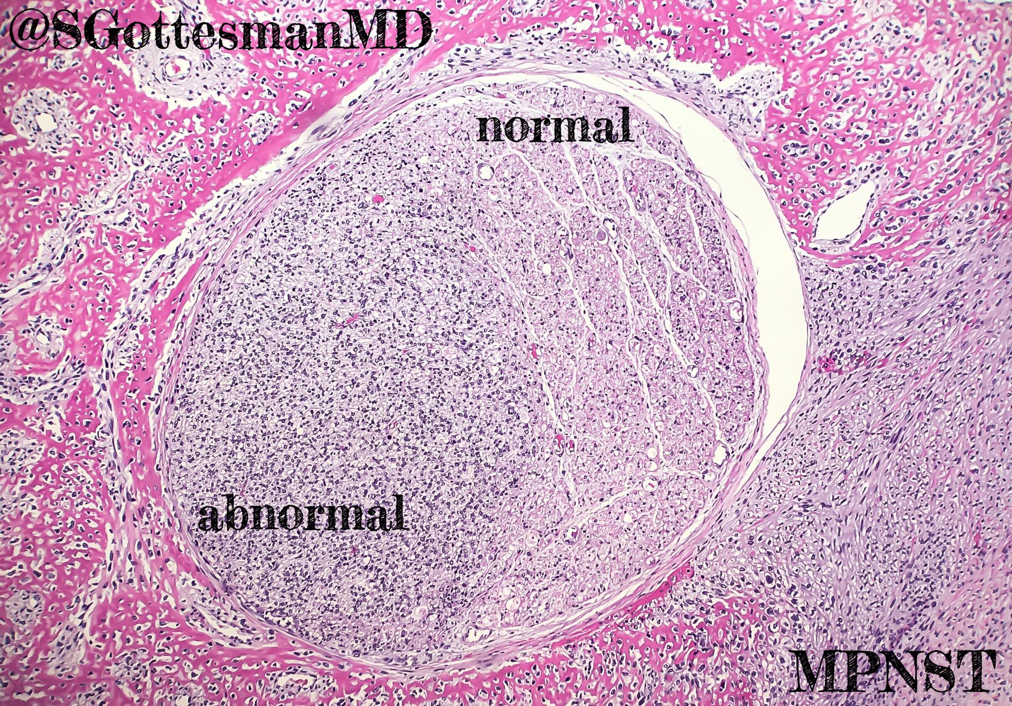 Mpnst Histology