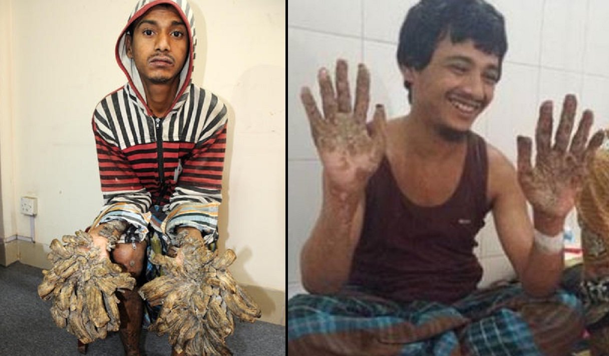 Tree Man Before And After