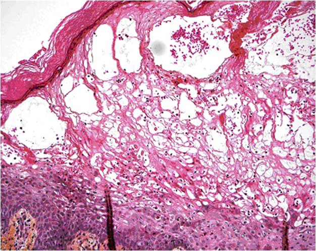 Acrodermatitis Enteropathica Histology