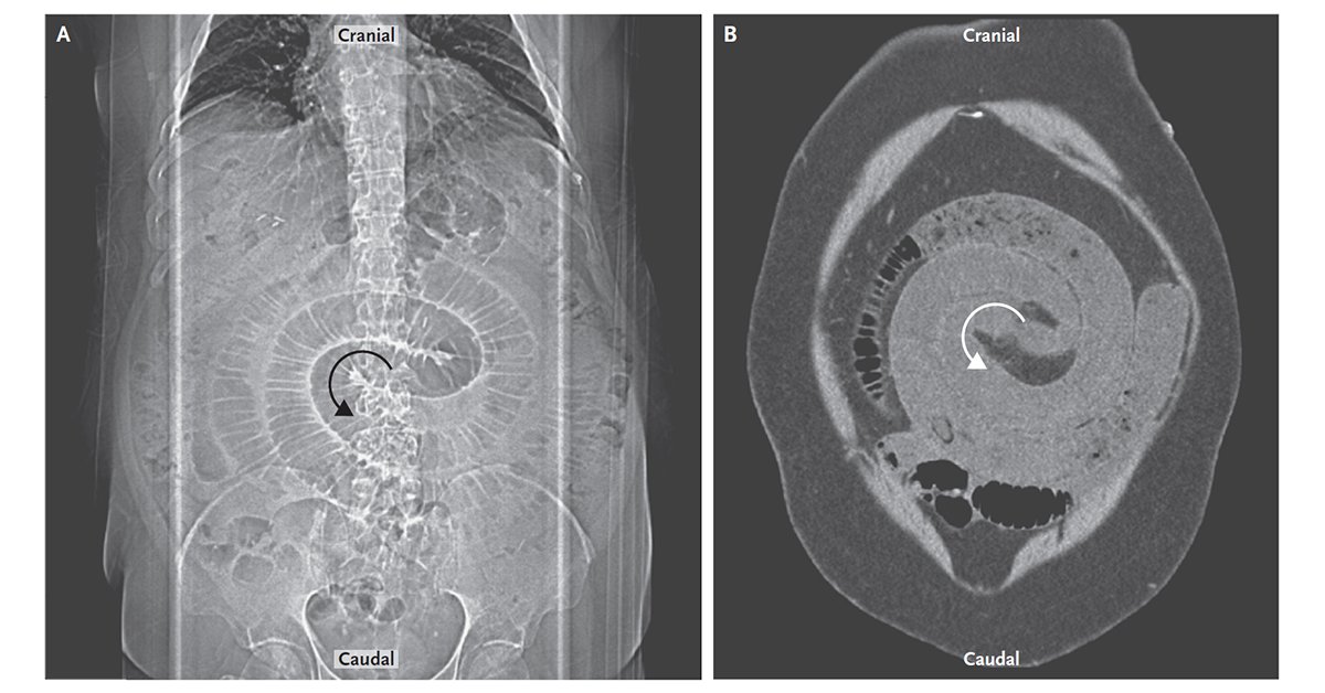 Image in Clinical Medicine: Swirl Sign — Intestinal Volvulus after Roux ...