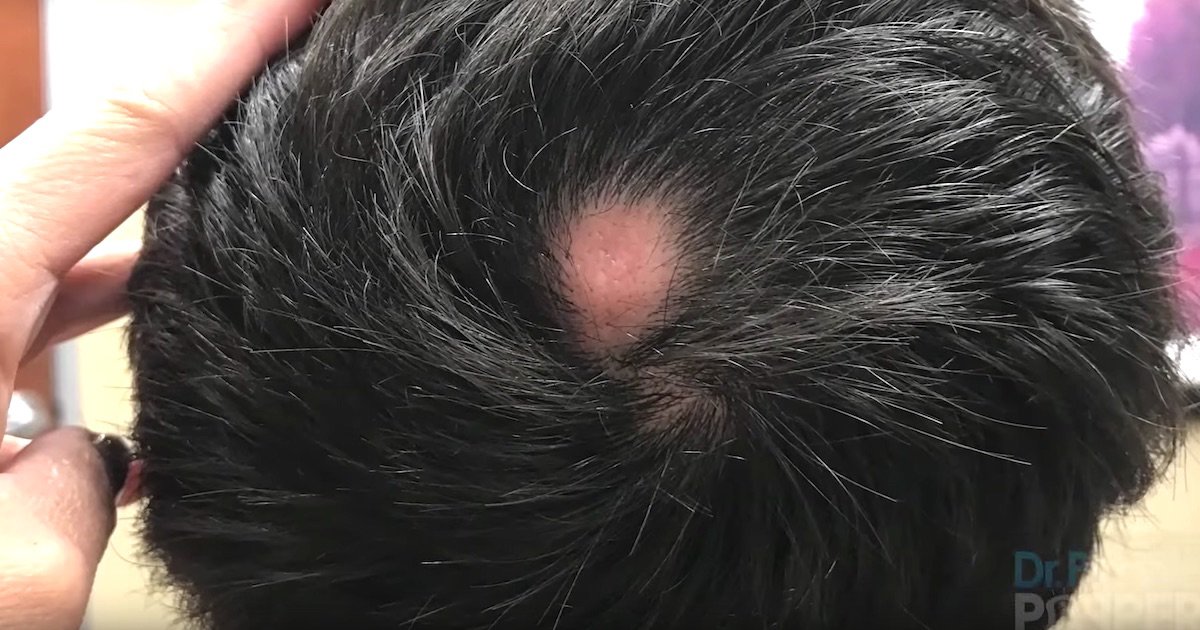 Scalp Pimple Pop