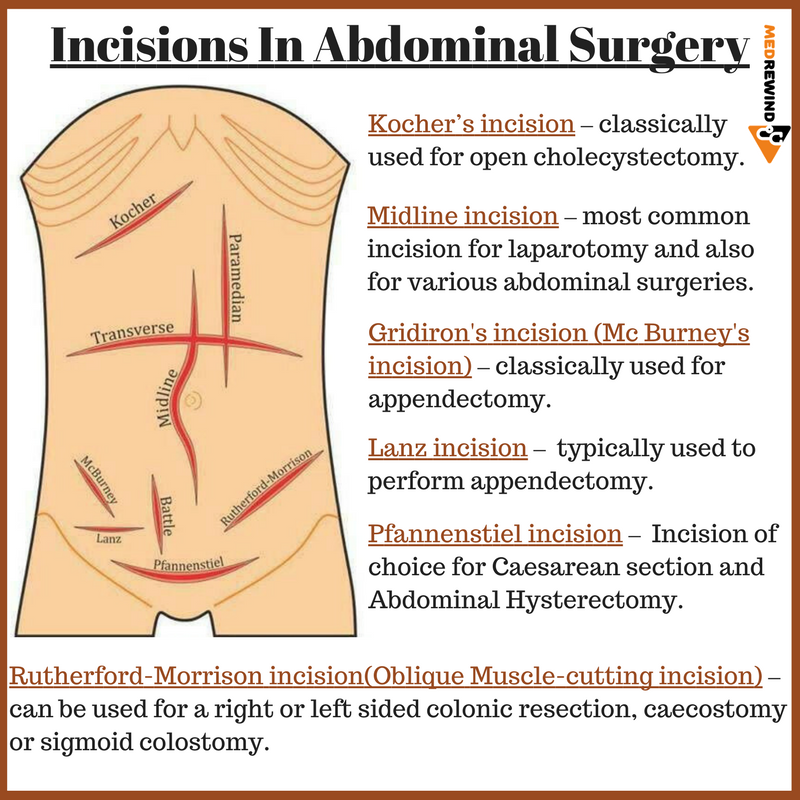 Open Appendectomy Incision