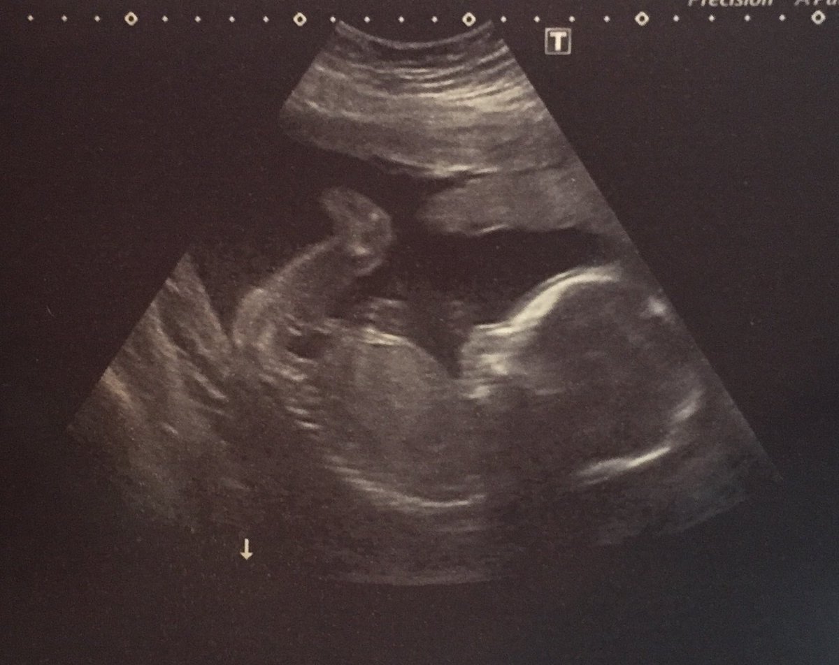 20 Weeks Pregnant Ultrasound Boy Ultrasound Of Fetus At 20 Weeks