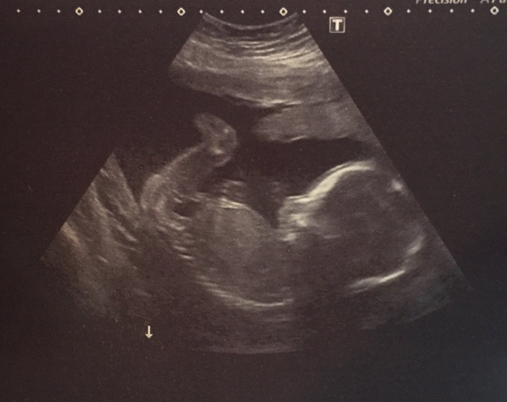 Healthy Baby Ultrasound Profile