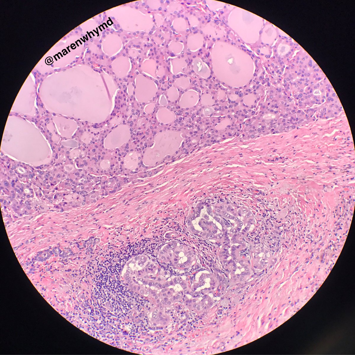 Hurthle Cell Histology