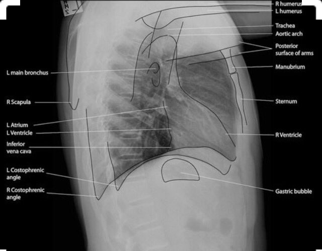 Anatomía De La Radiografía De Tórax Lateral