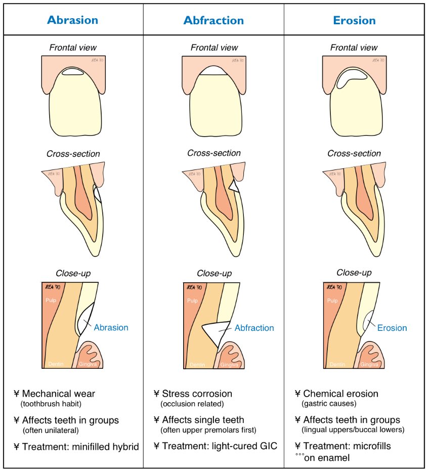 Tooth Abfraction