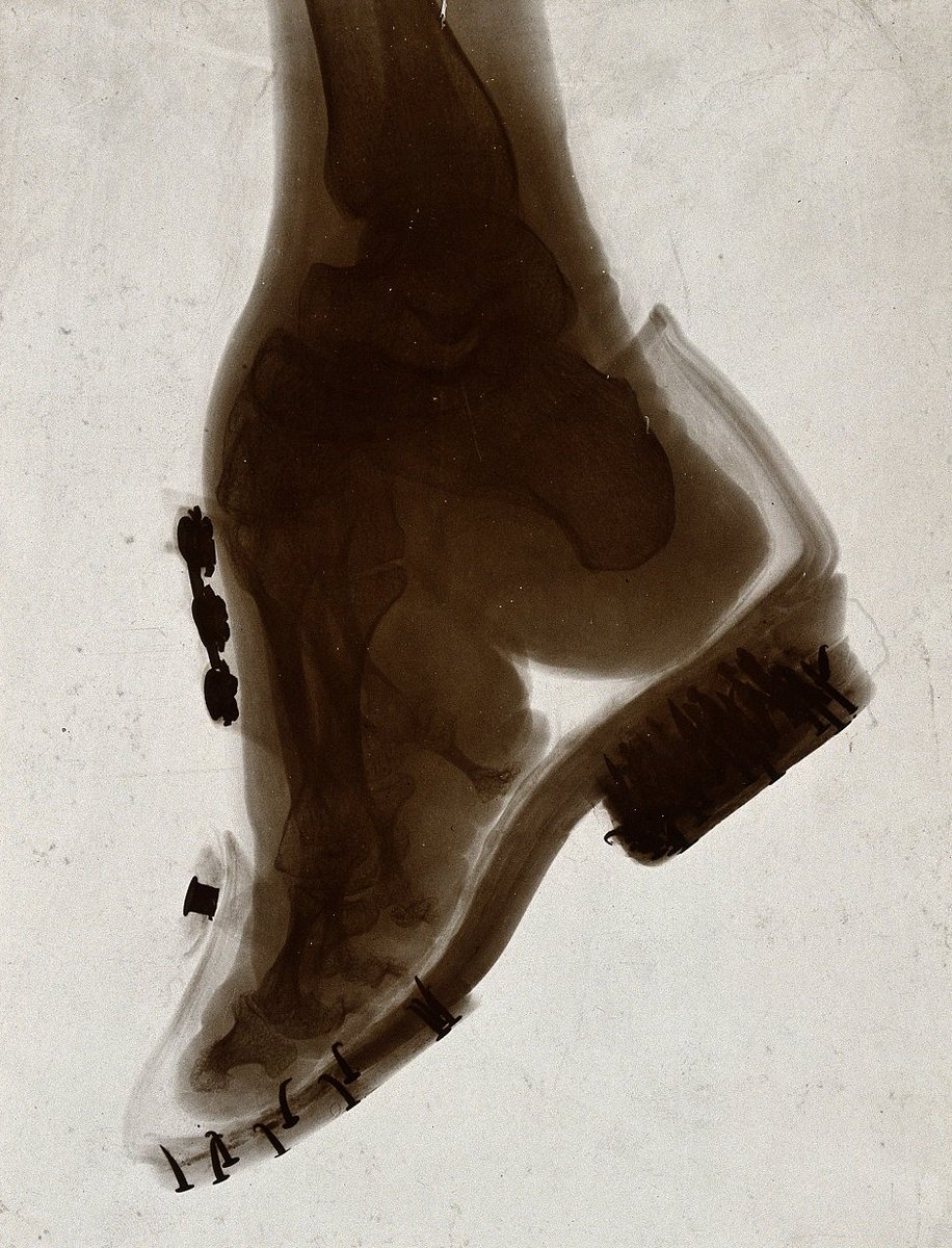 Foot x-ray of a 43 year old Chinese woman showing the effects of foot ...