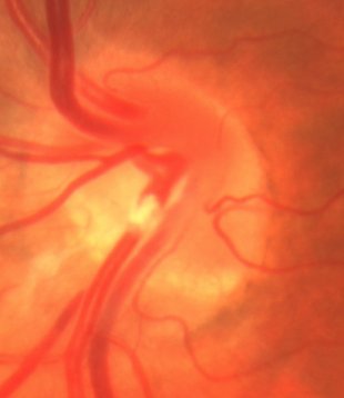 Hollenhorst Plaque Carotid Artery