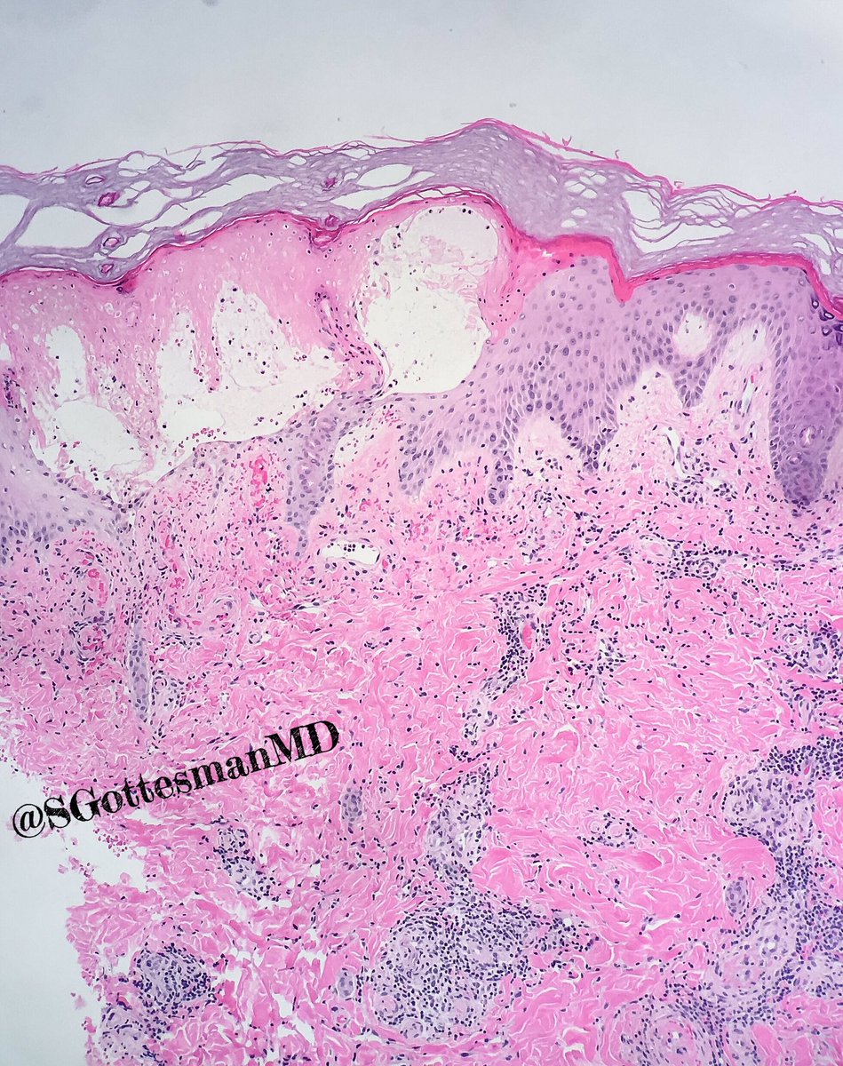 Eritemamultiformehistologiaoral
