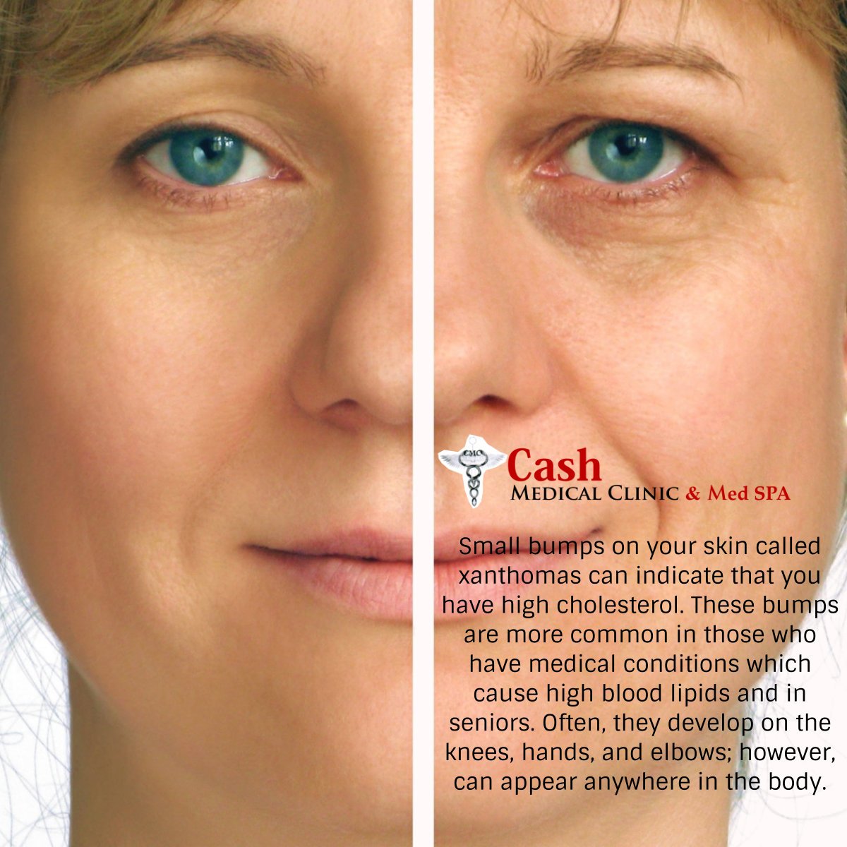 Xanthomas Face