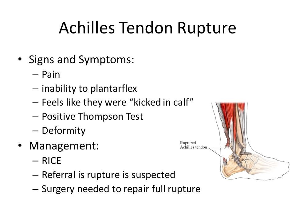 Torn Achilles Tendon Symptoms