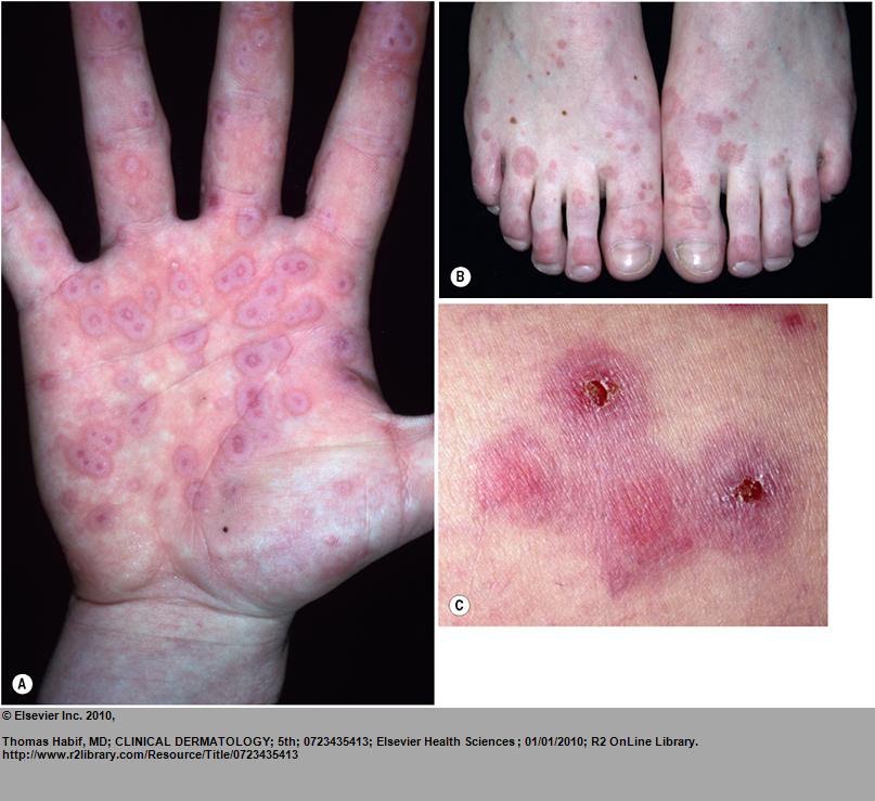 Erythema Multiforme Target Lesions