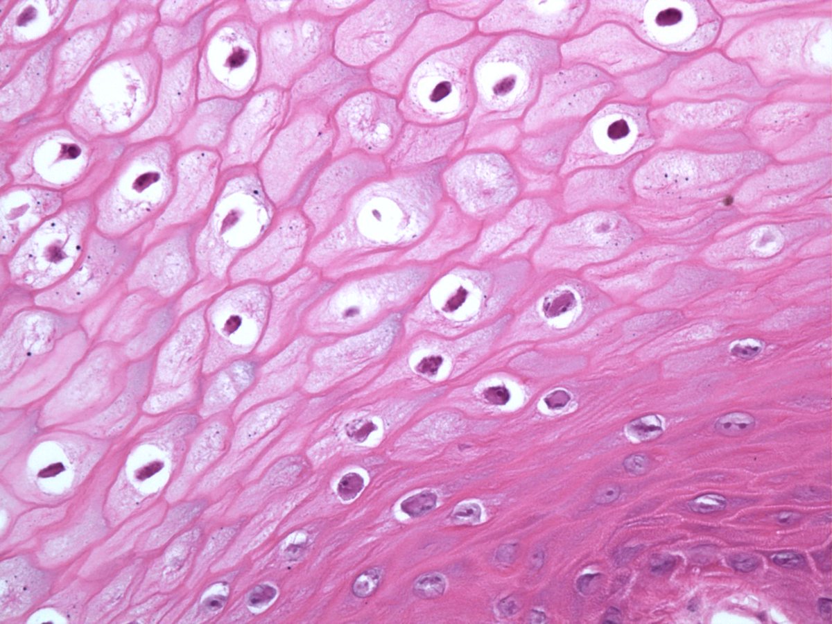 Hairy Leukoplakia Histology