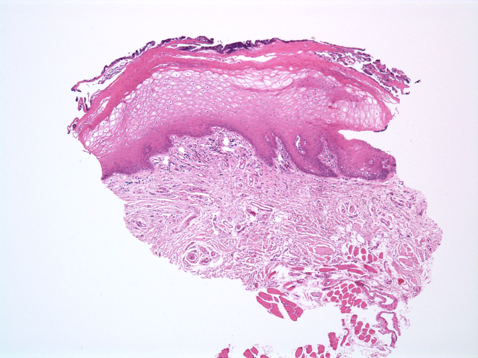 Hairy Leukoplakia Histology
