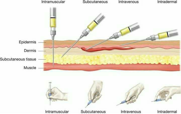 Intravenous Injection Angle