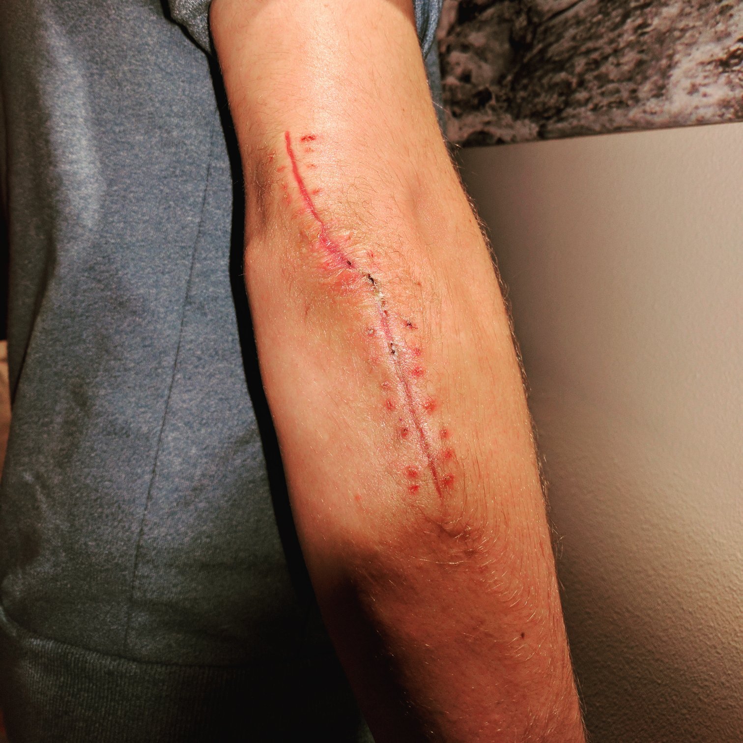 Minor Stitches On The Arm