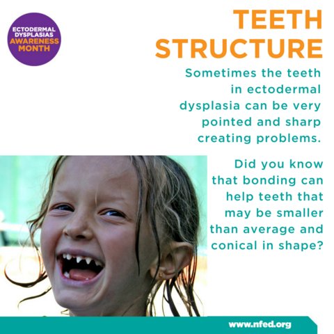 Ectodermal Dysplasia Teeth
