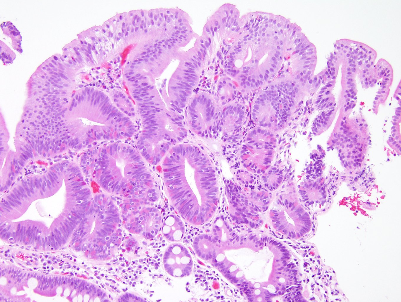 Tubular Adenoma Histology