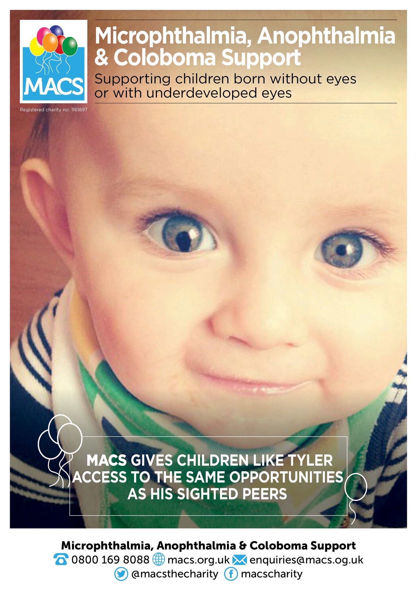 Anophthalmia No Eyes