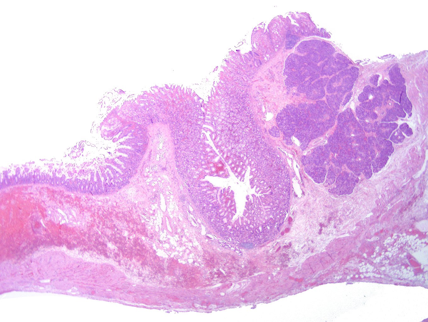 Meckels Diverticulum Histology
