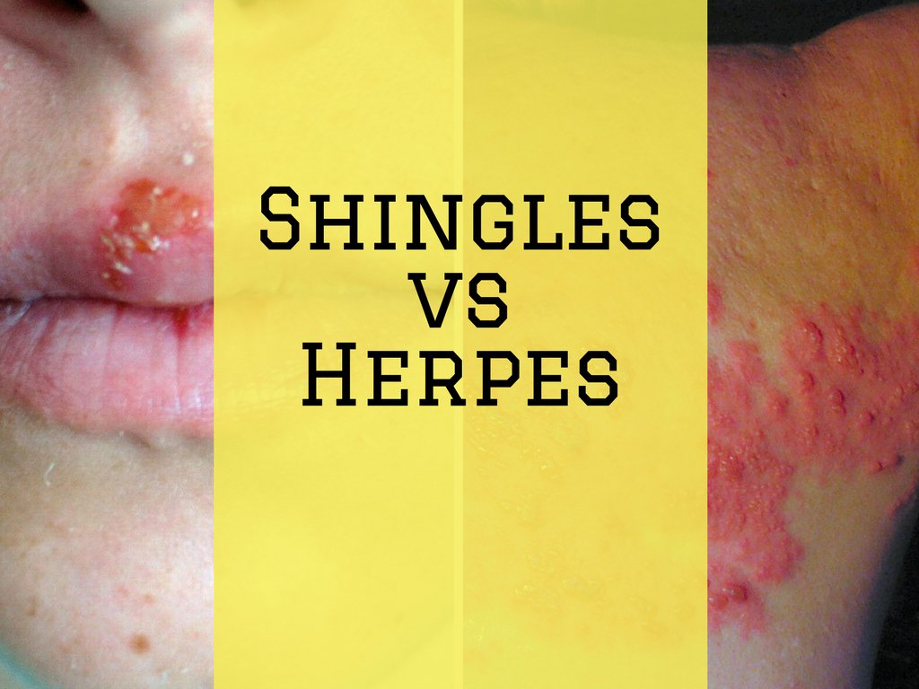 Herpes Zoster Vs Herpes Simplex