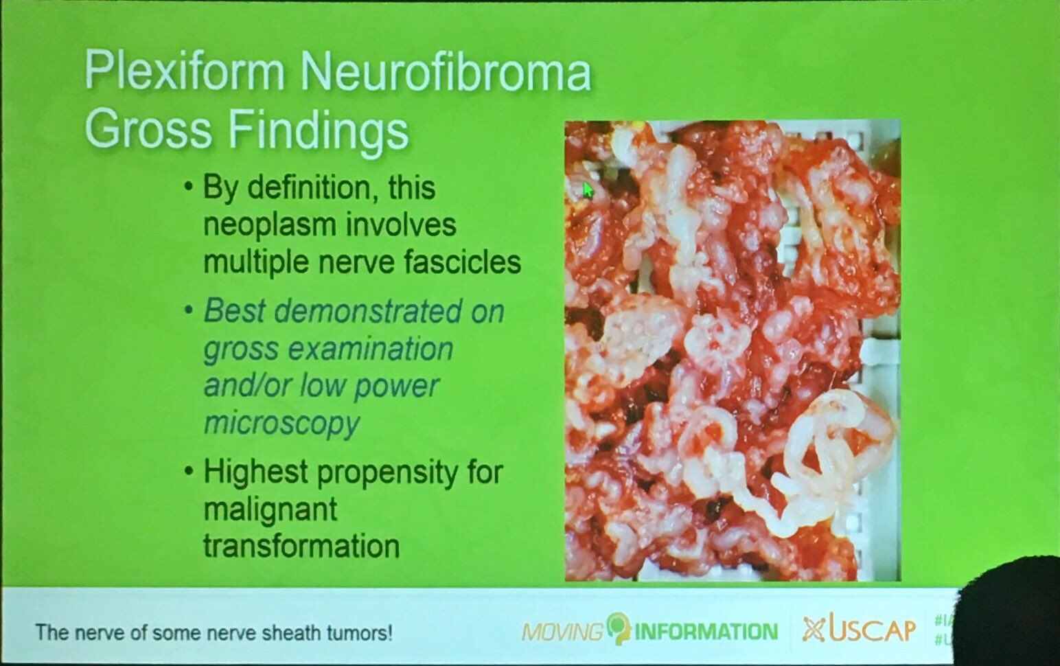 Plexiform Neurofibroma Gross