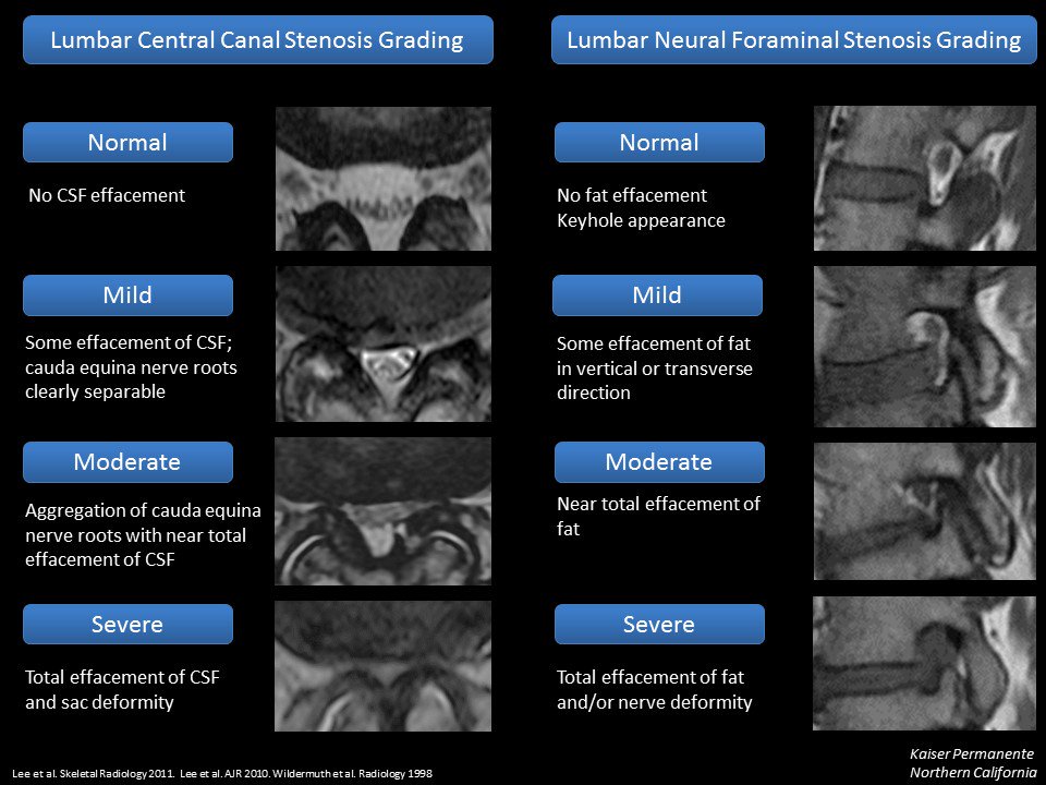 Lumbar Neural Foraminal Stenosis