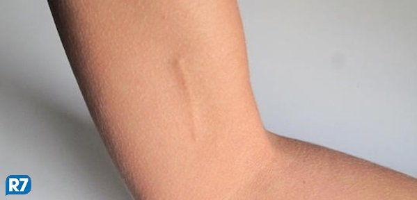 Conheça o implante subcutâneo: método contraceptivo que promete ...