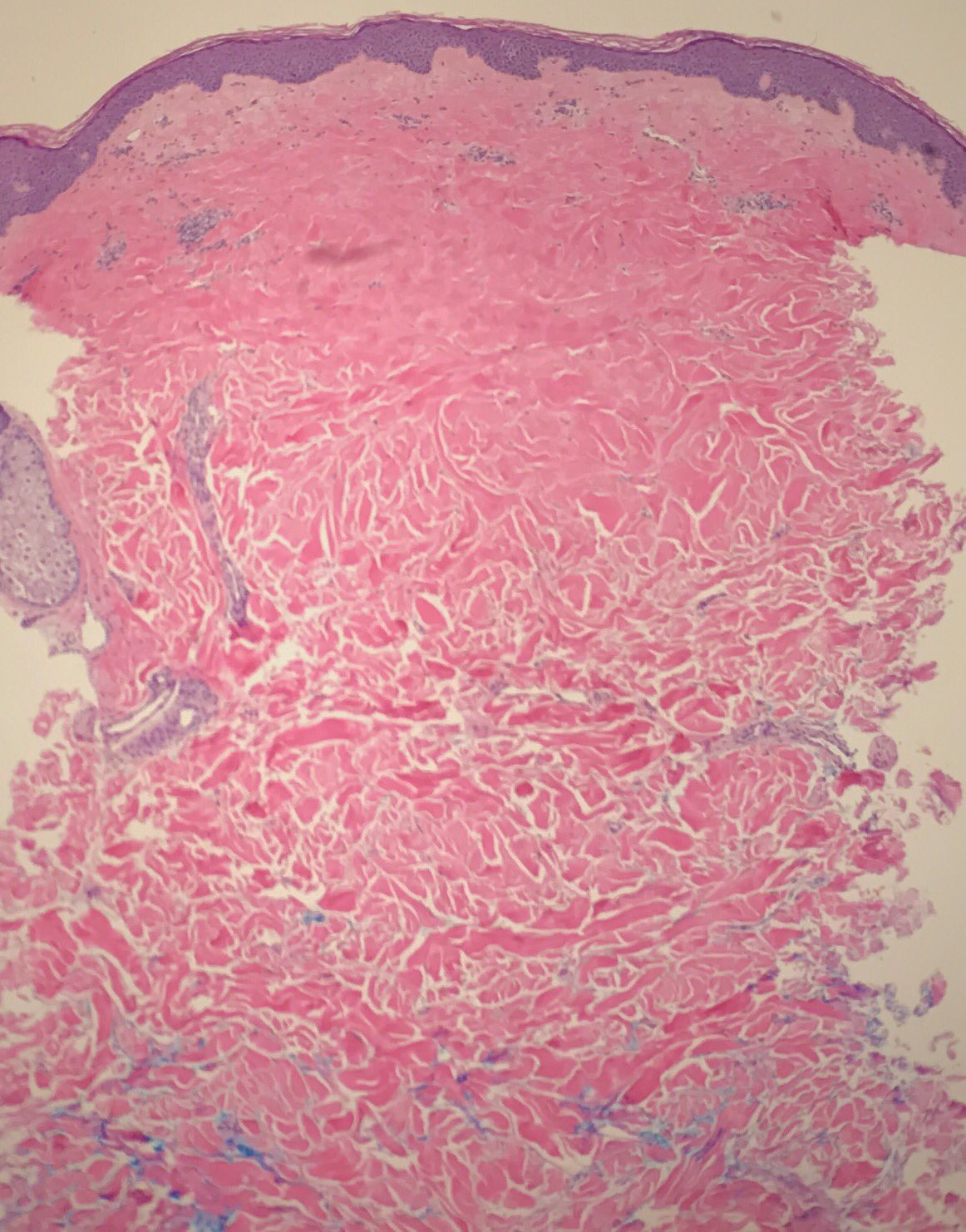 Morphea Histopathology