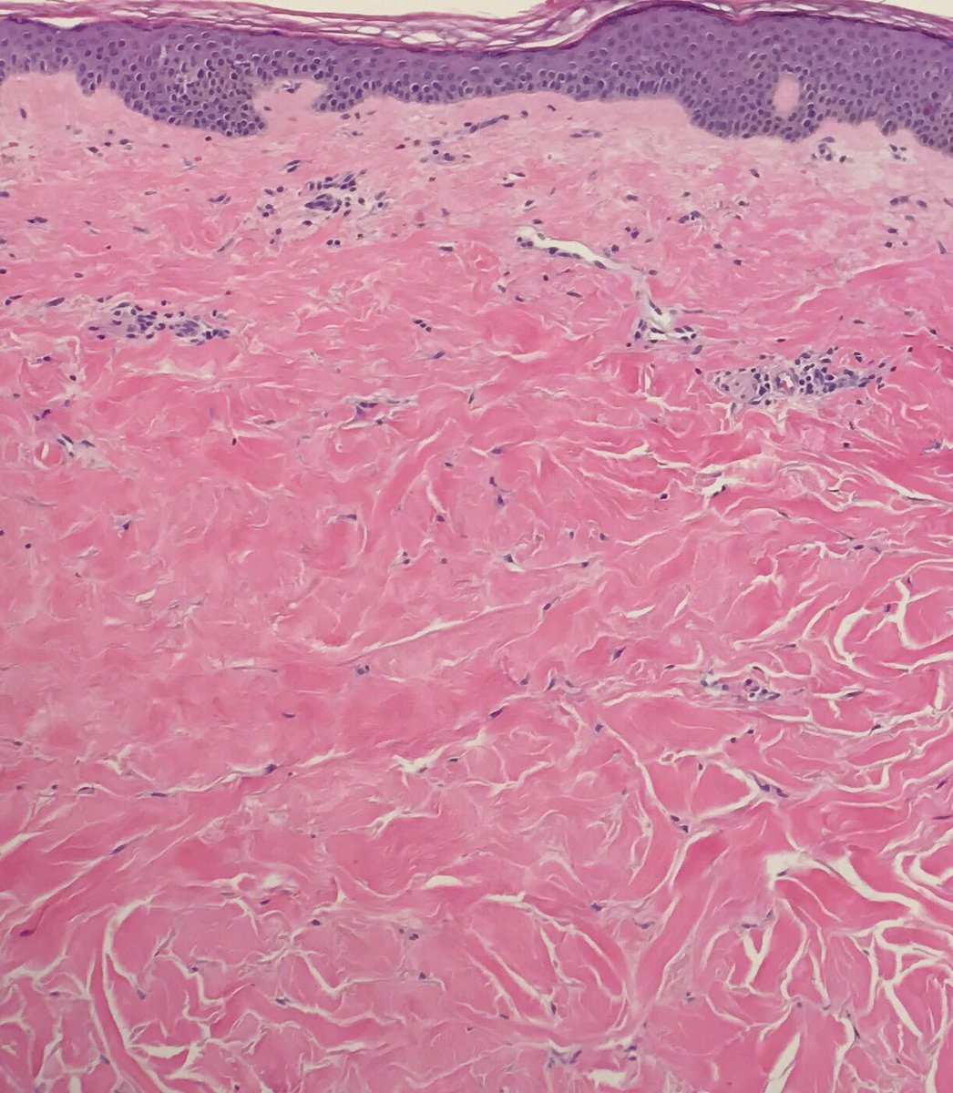 Morphea Histopathology