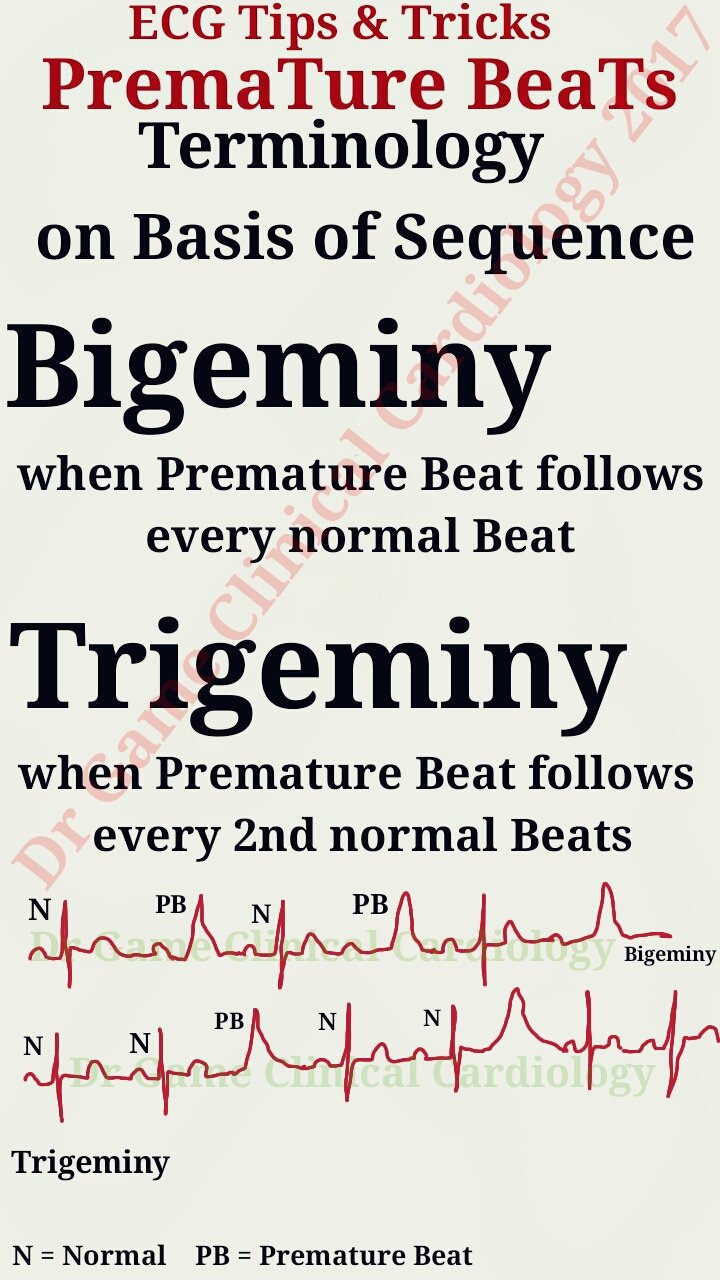 Ventricular Trigeminy