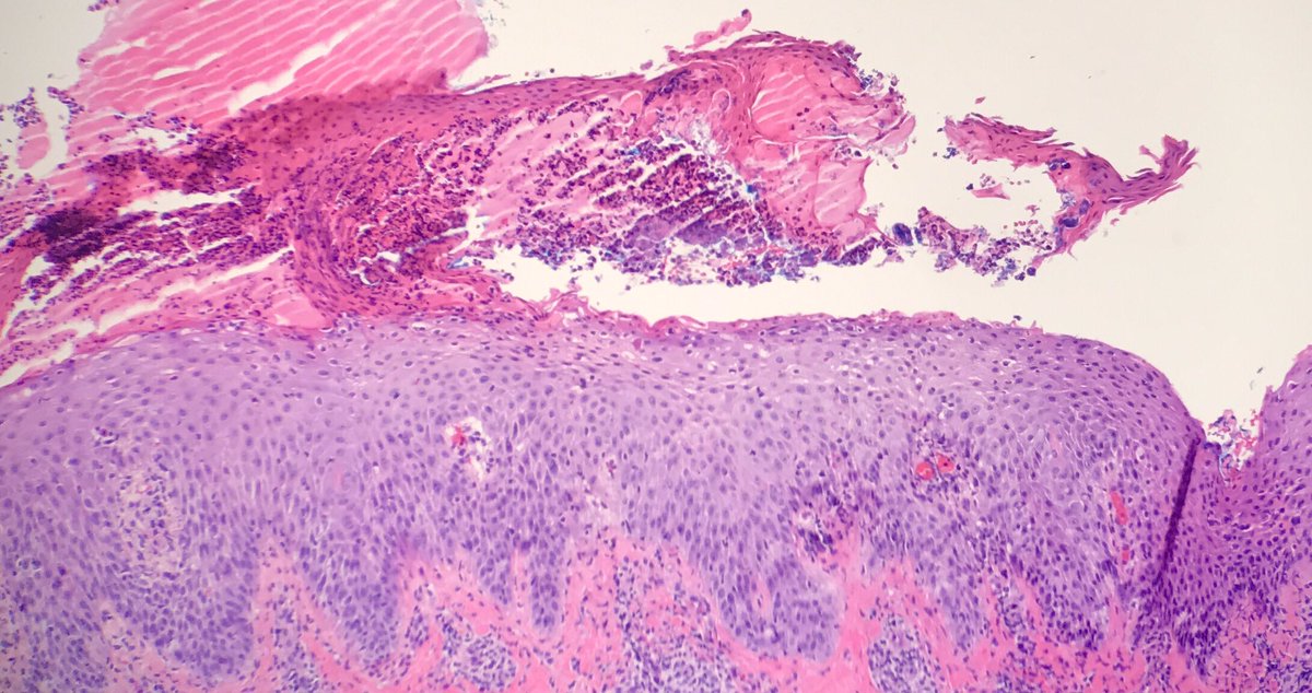 Bullous Impetigo Histology Educational Case: Bullous Pemphigoid