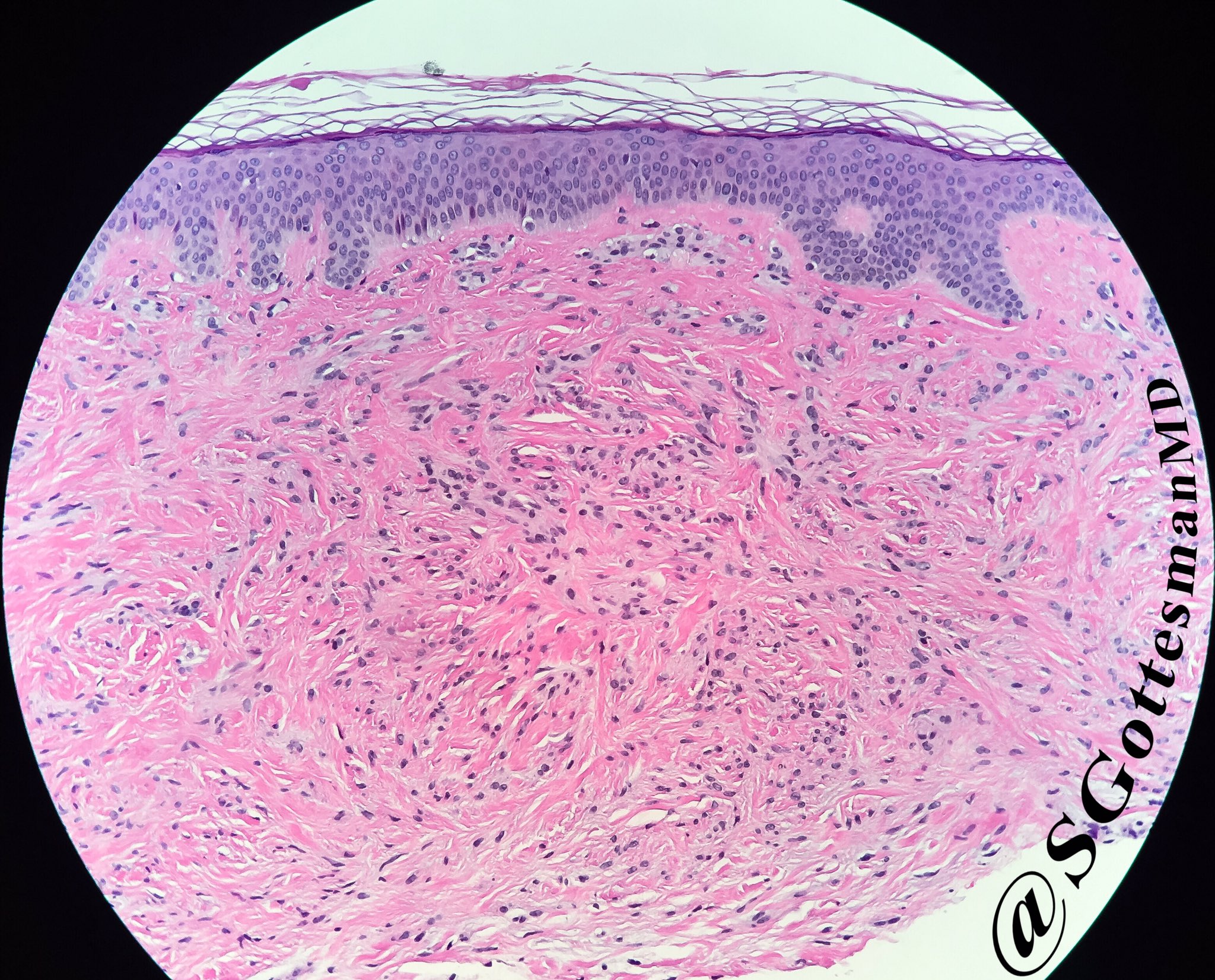 Blue Nevus Histology