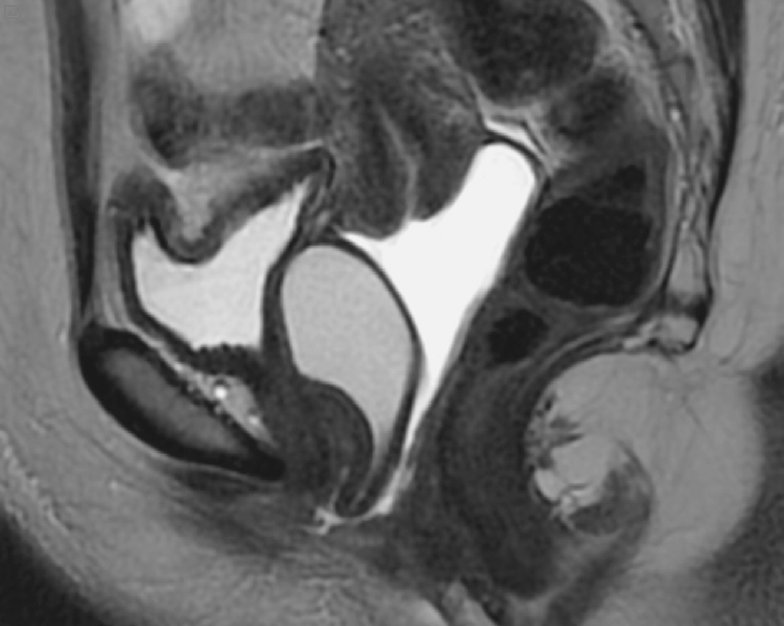 Gartners Duct Cyst Benign Lesions Of The Vaginal Wall | Obgyn Key