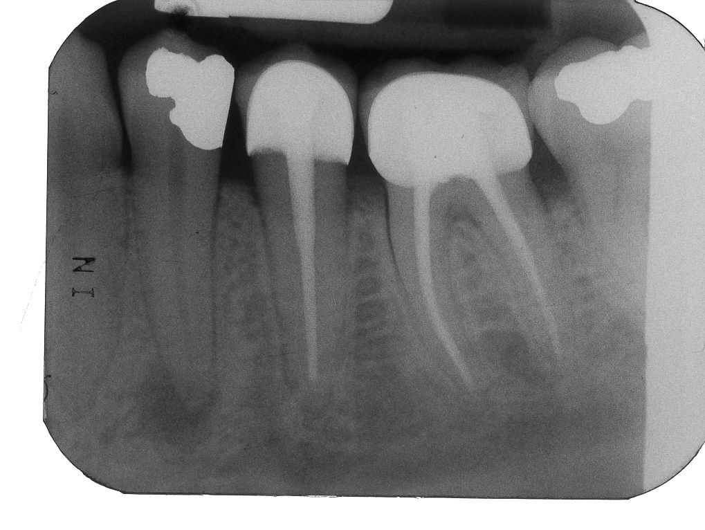 Radiolucent Rarefying Osteitis