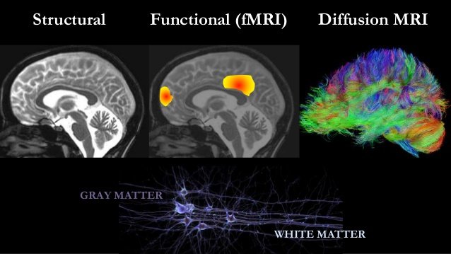 machinelearning algorithm can help predict depression based on MRI ...