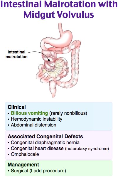 Volvulus Malrotation