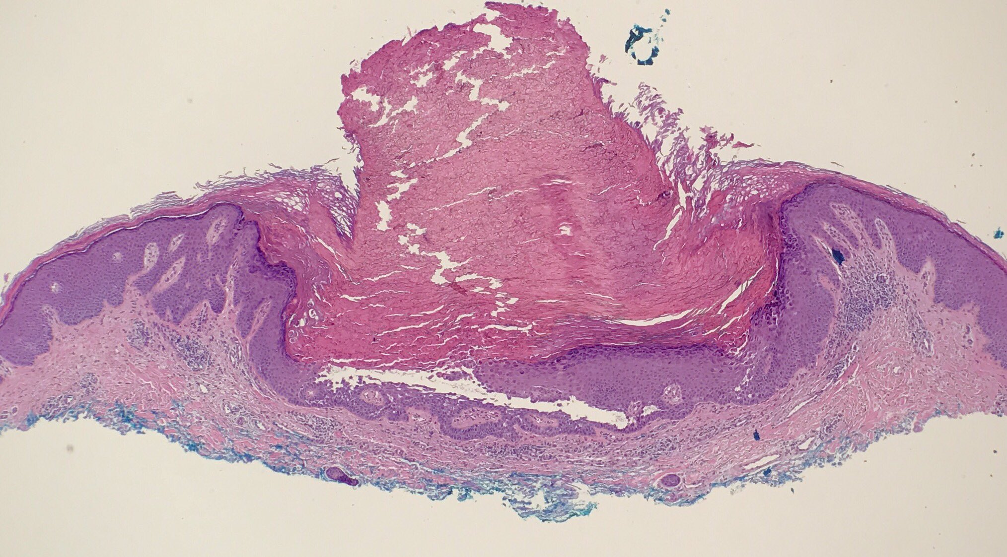 Warty Dyskeratoma
