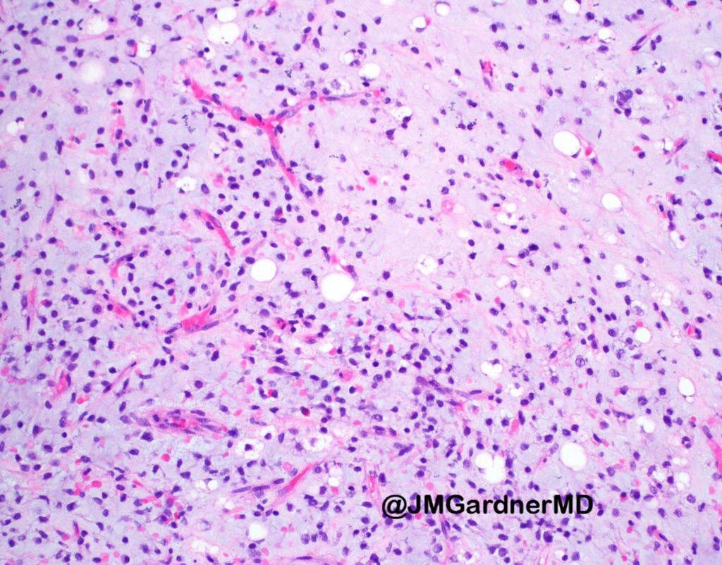 Liposarcoma Histology