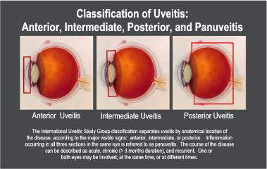 Panuveitis