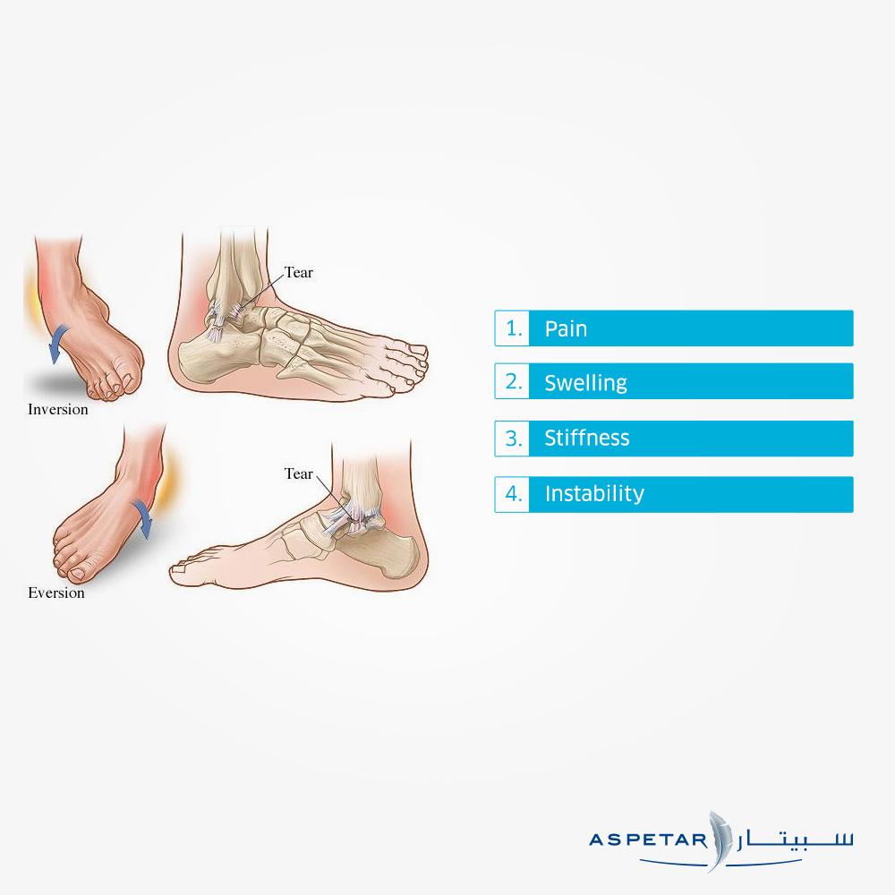 High Ankle Sprain Swelling