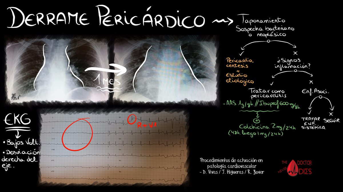 Radiografia De Derrame Pericardico MediClases Fácil