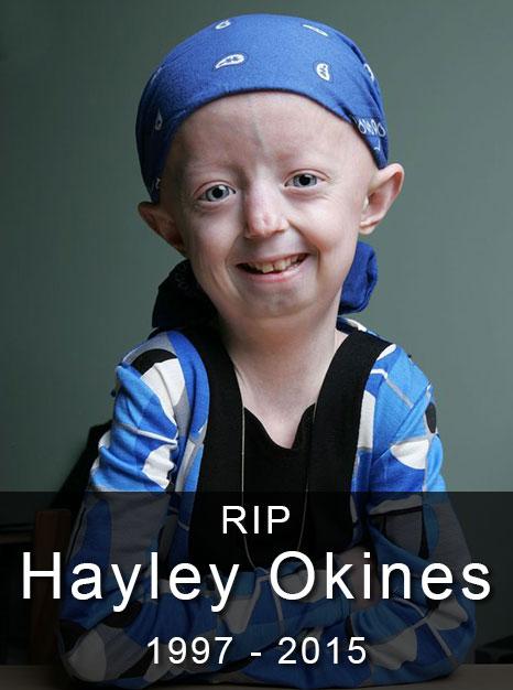 Hayley okines's #progeria; a condition that could give clues to the ...
